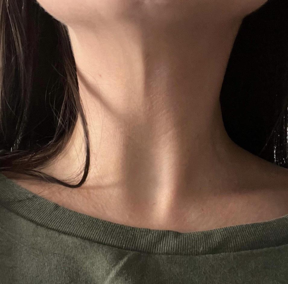 Say Goodbye to Sagging Skin: How a Neck Lift Can Treat Neck Laxity ...