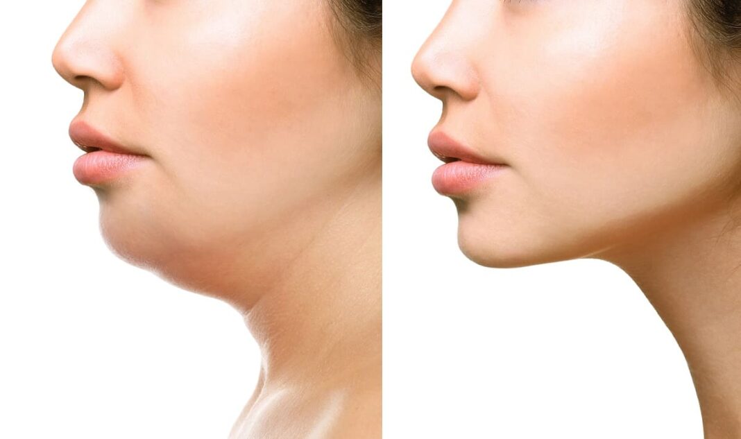 Say Goodbye to Sagging Skin: How a Neck Lift Can Treat Neck Laxity ...